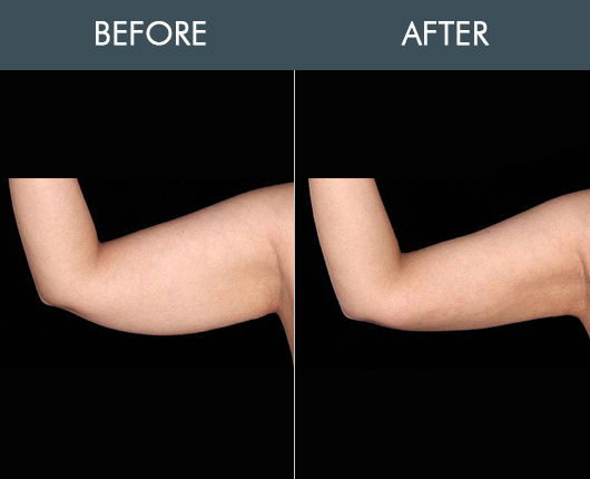 Bodytite Orlando | Radio Frequency Skin Tightening Florida